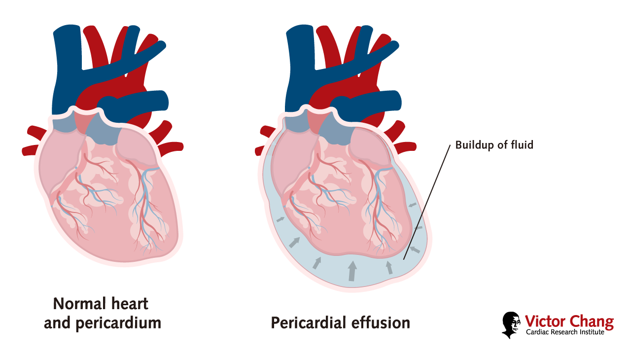 Pericardial effusion | Victor Chang Cardiac Research Institute
