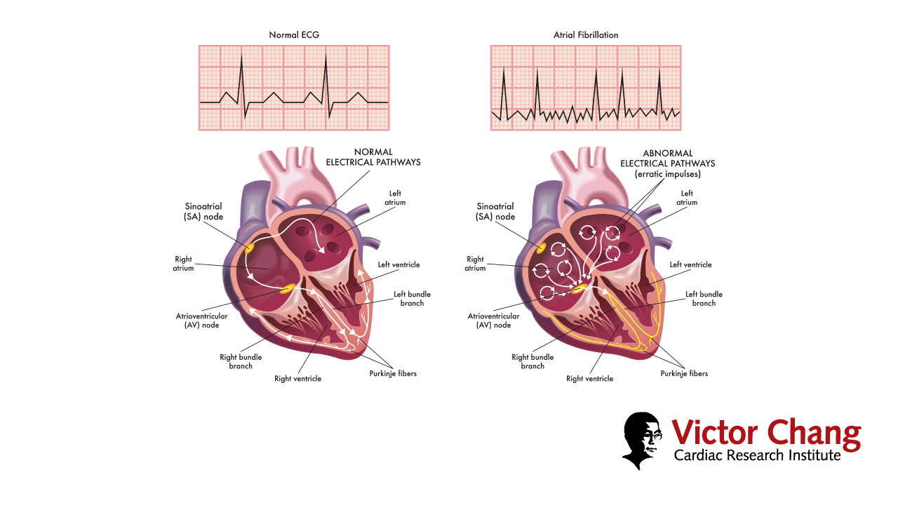 What is atrial fibrillation? | Victor Chang Cardiac Research Institute