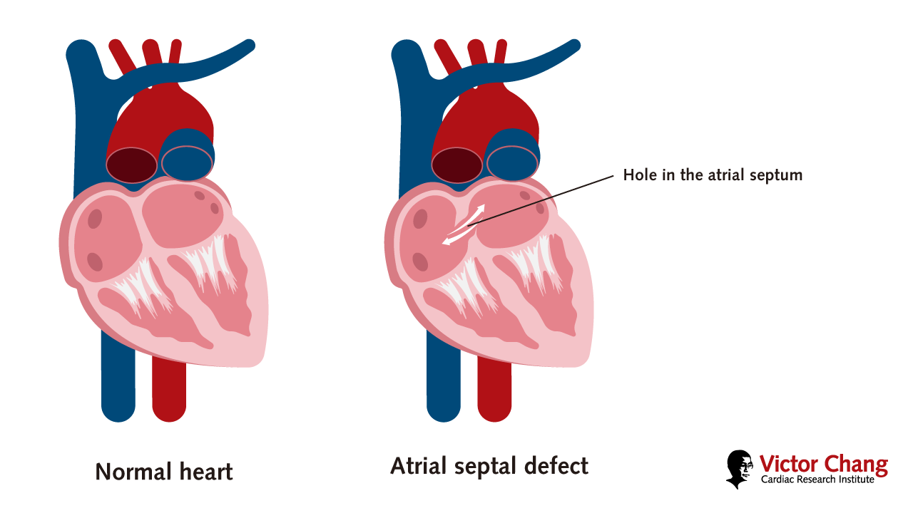 Atrial Septal Defect (ASD):… | Victor Chang Cardiac Research Institute
