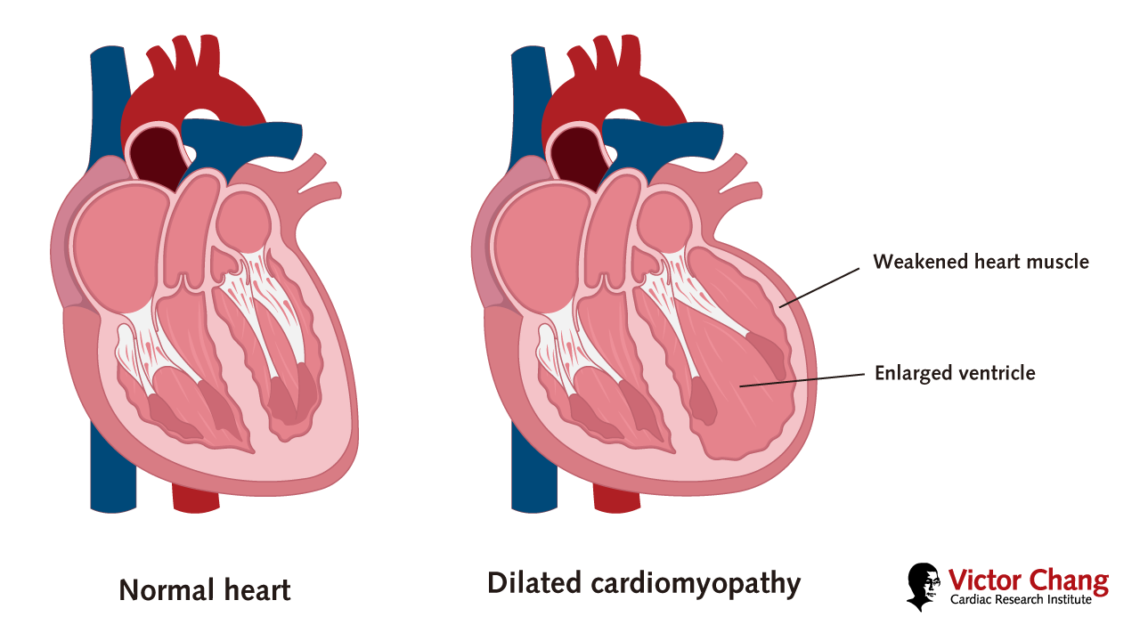 Dilated cardiomyopathy (DCM) | Victor Chang Cardiac Research Institute