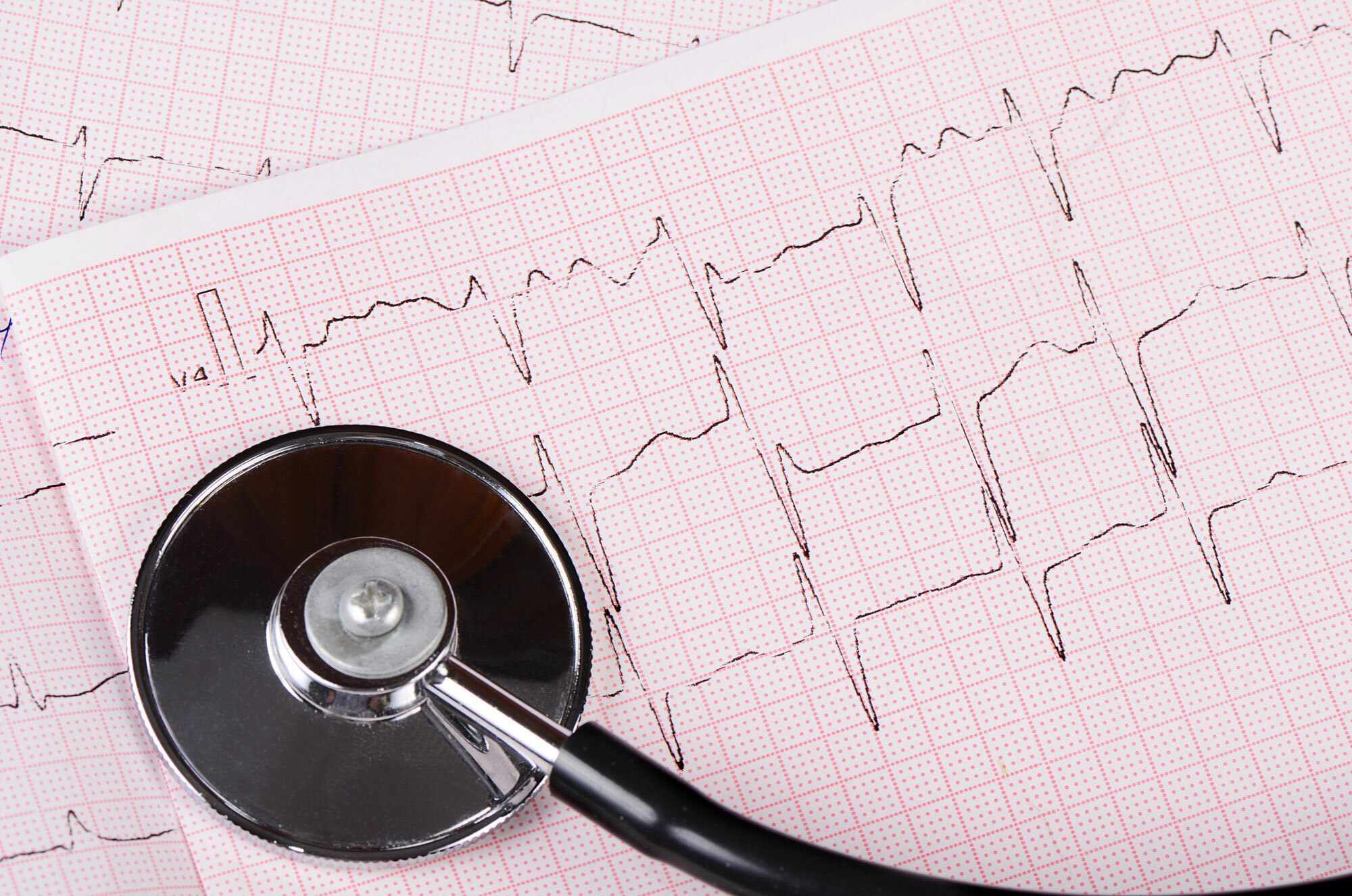 What is Arrhythmia - Victor Chang Cardiac Research Institute