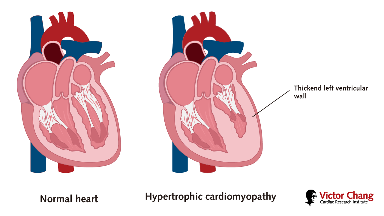 Hypertrophic cardiomyopathy… | Victor Chang Cardiac Research Institute