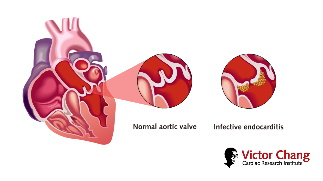 Endocarditis: Symptoms,… | Victor Chang Cardiac Research Institute