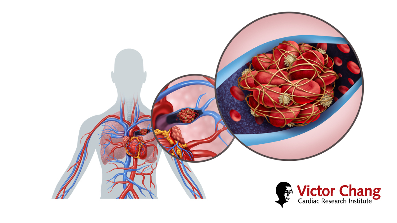Pulmonary Embolism:… | Victor Chang Cardiac Research Institute